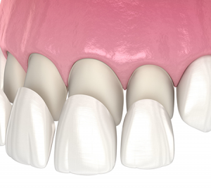 Veneers - Langley Road Dental Practice